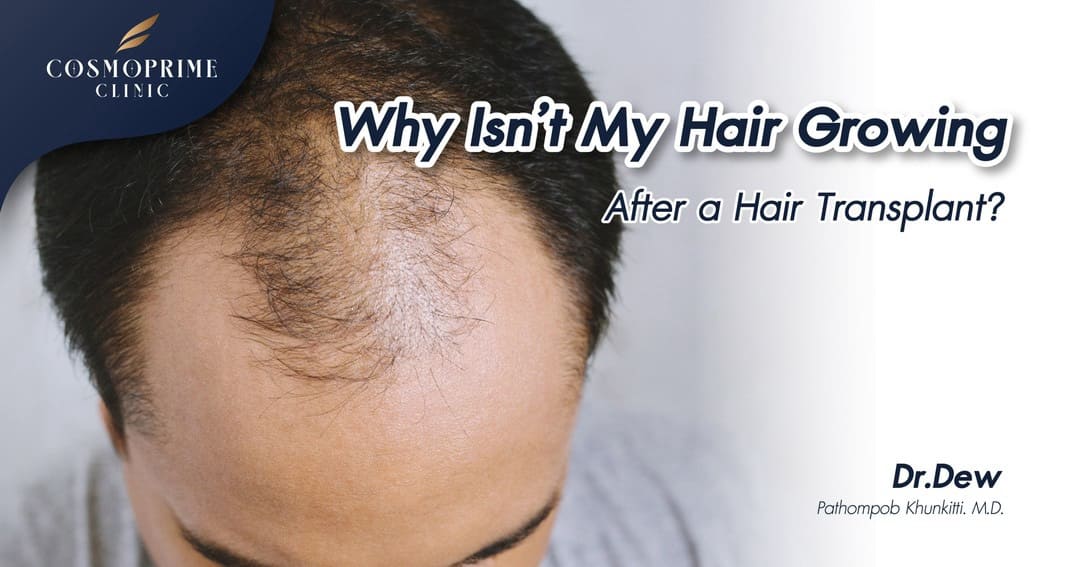 Why Isn’t My Hair Growing After a Hair Transplant? | cosmo hair center